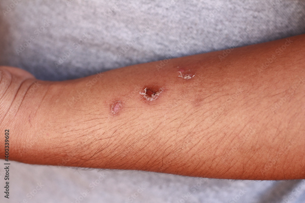Skin Diseases On Arms