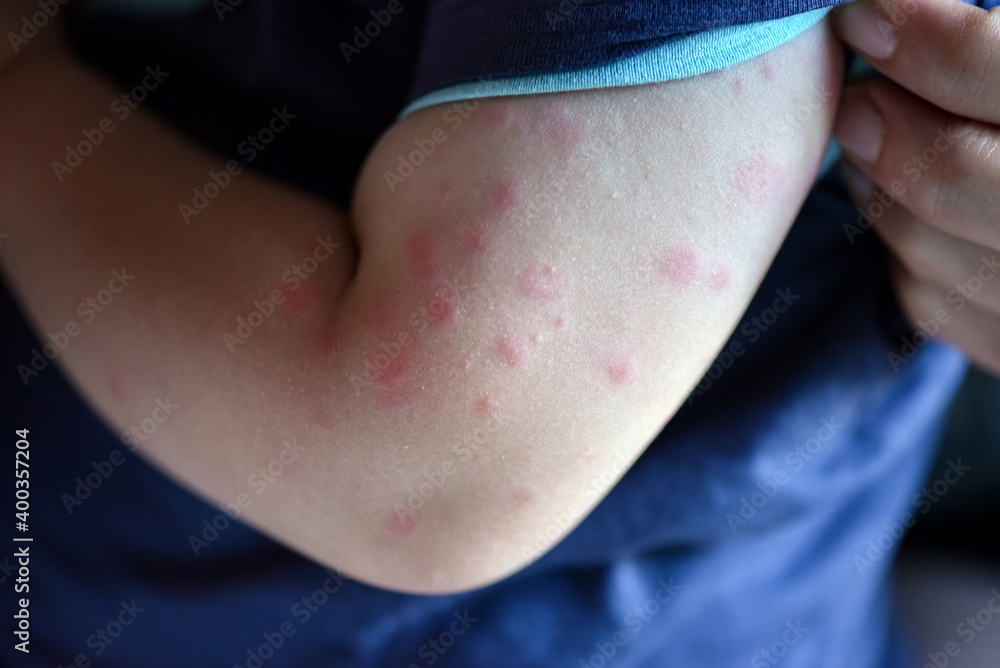 Child with hives on his arm. Hives, also known as urticaria, is a kind ...