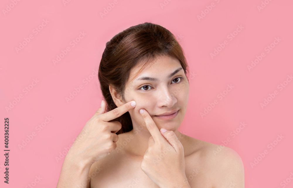 Acne treatment. Acne woman. Young woman squeezing her pimple, removing ...