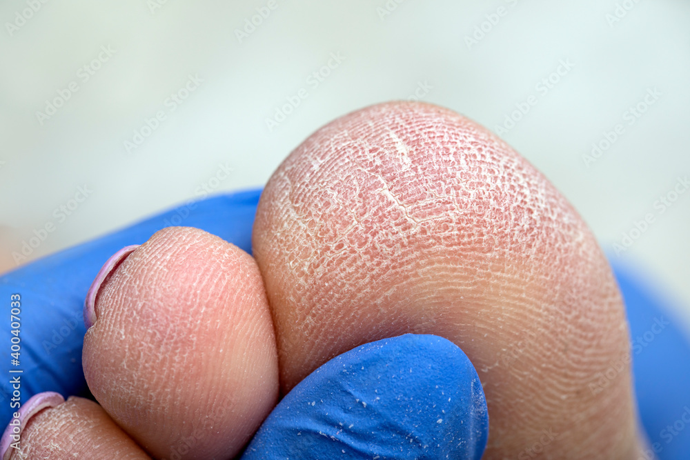 Dry skin of the feet with cracks. Medical pedicure in the salon. Stock ...