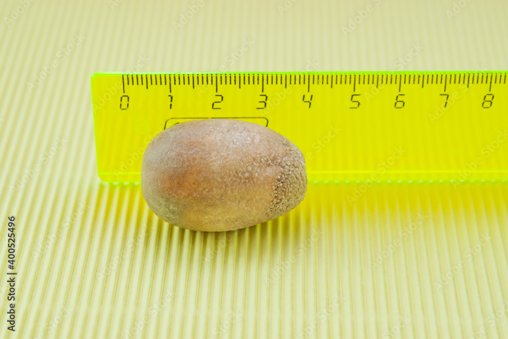 A large oval stone cut from the gallbladder during cholecystectomy ...