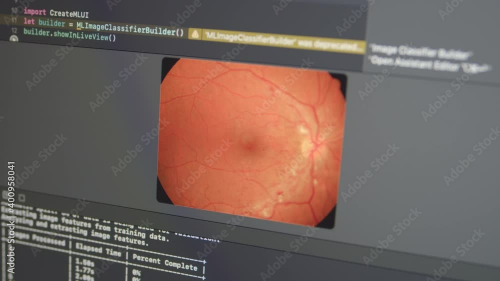 Video „diabetic And Hypertensive Retinopathy Glaucoma Detection With