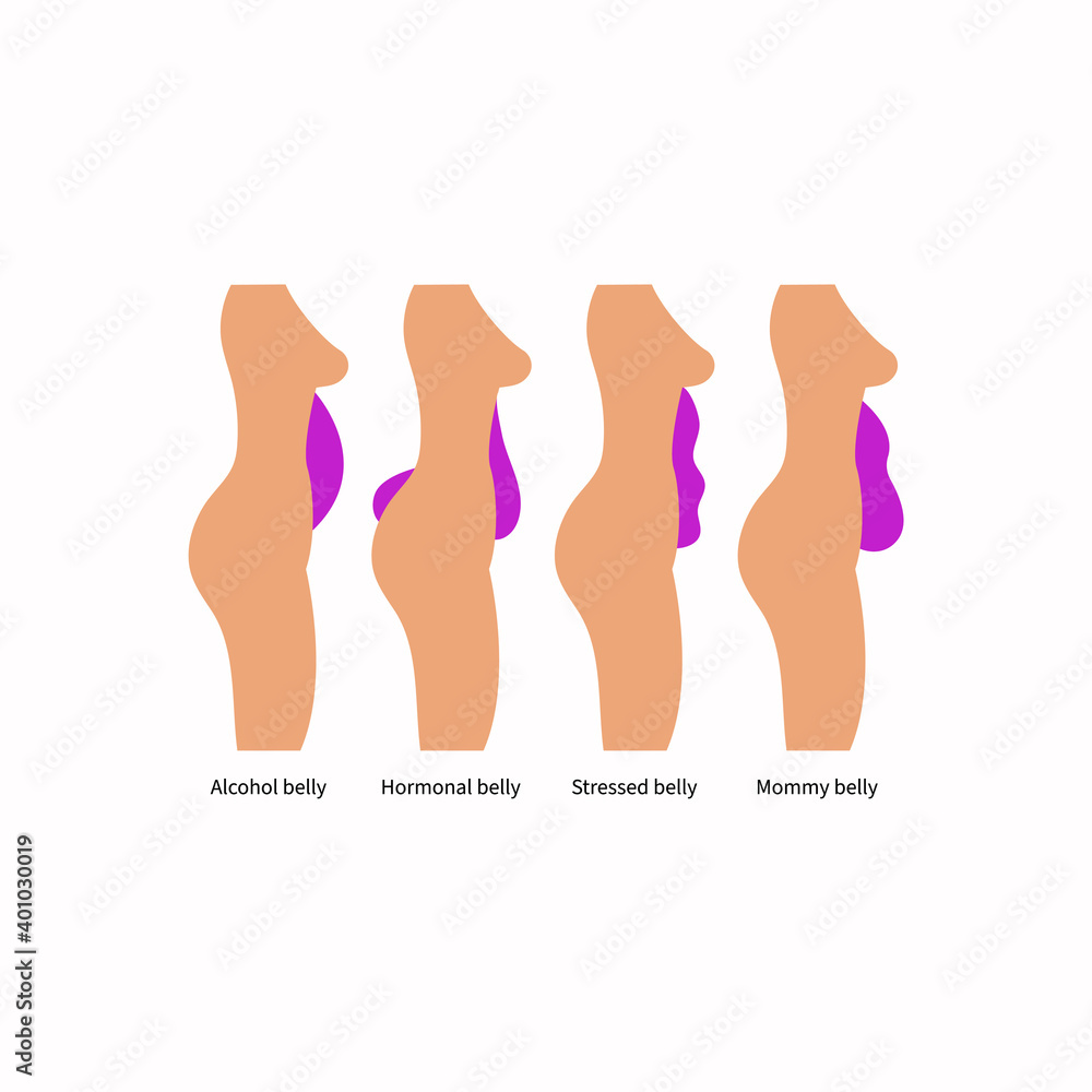 Different types and causes of abdominal obesity in women Stock Vector ...