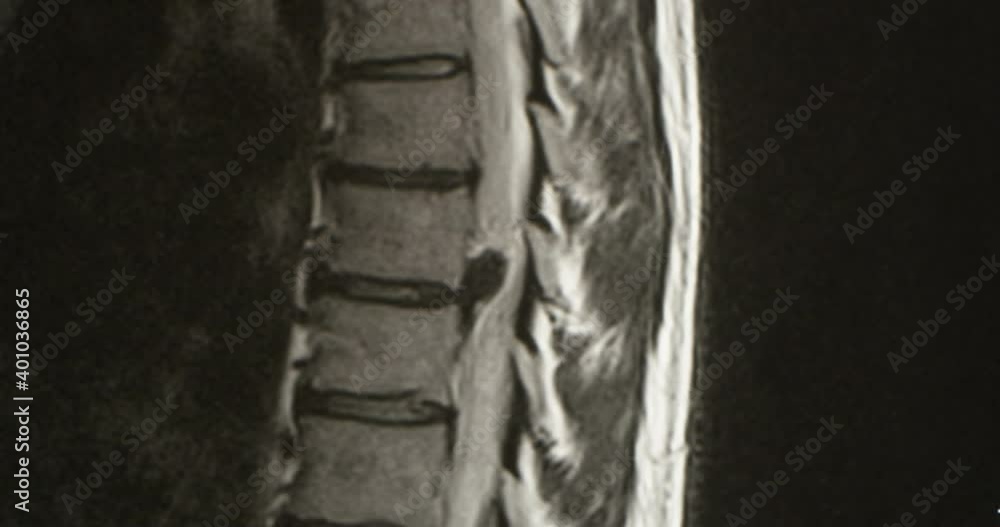 Examining an MRI Scan of Lumbar Spines of a Patient with Chronic Back ...