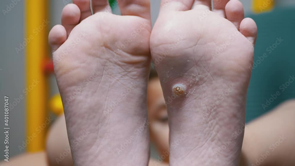Callus and Wart Feet on Plantar Flat foot in Child. Flat feet. Close-Up ...