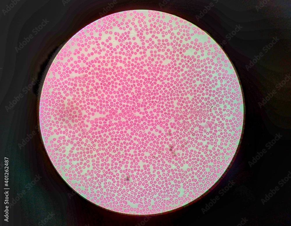 Red blood cell of humen was dyed by Wright's stain. The red blood cell ...