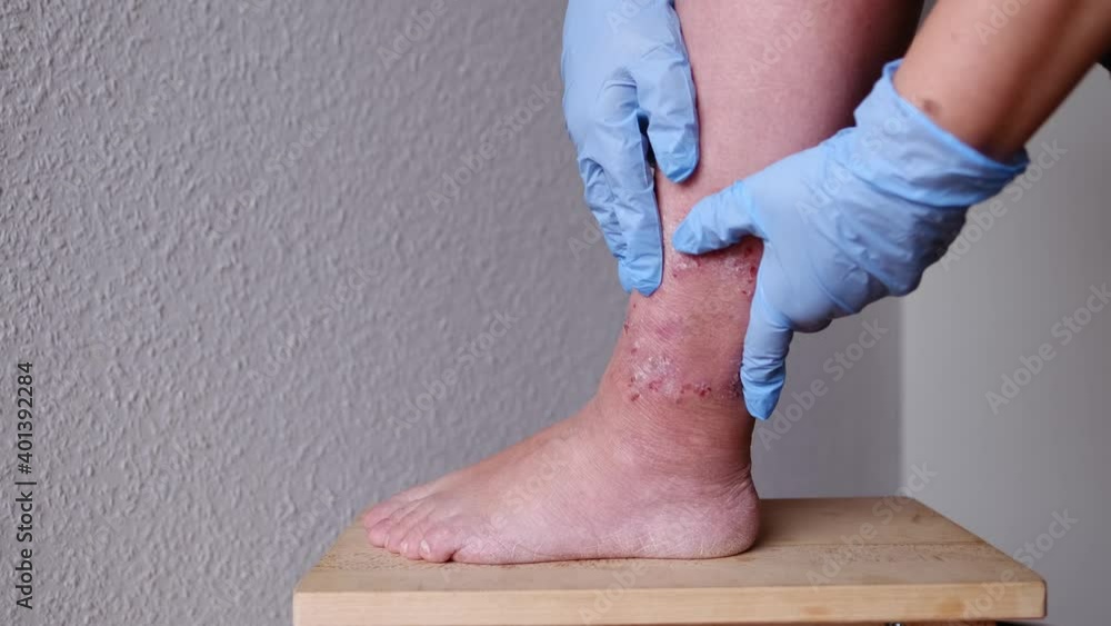 doctor treats a large healing wound from on lower leg with scars of ...