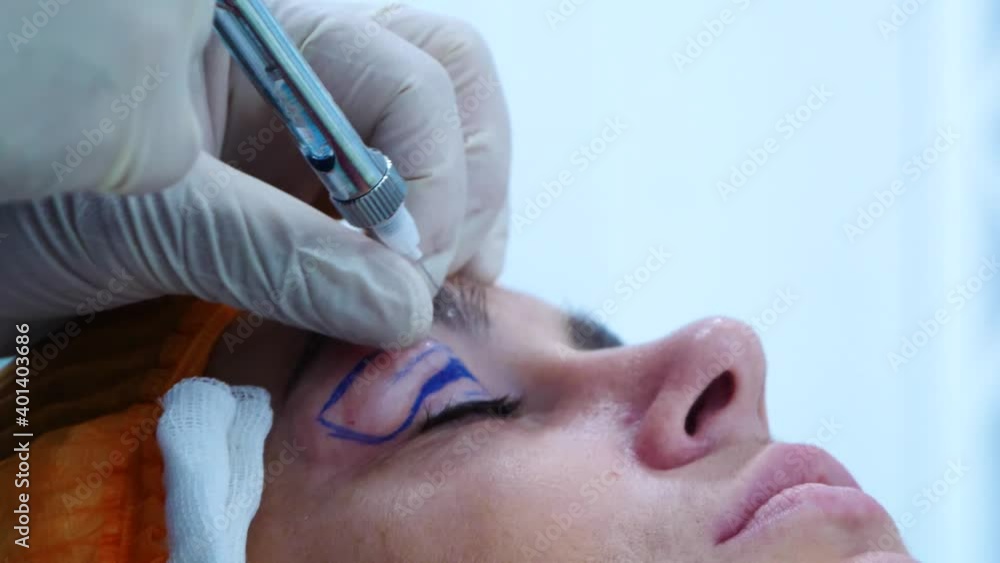 Upper blepharoplasty. The surgeon puts an injection in the eye ...