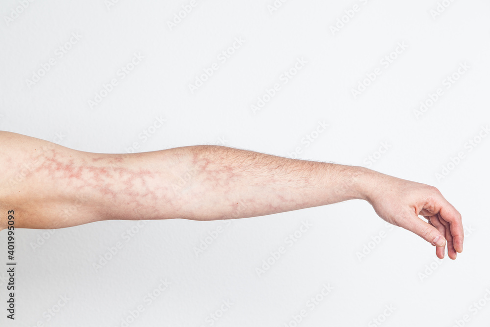 Male upright left arm with red skin capillary network Stock Photo ...