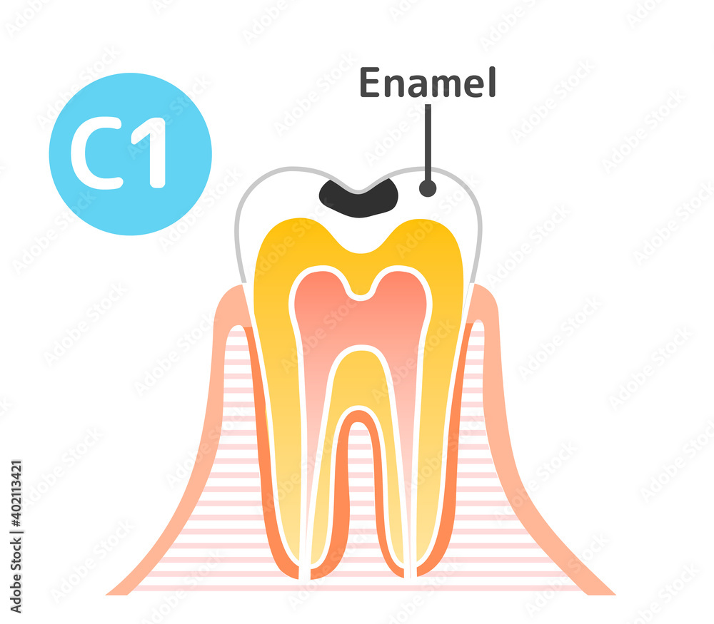Caries and Progression and Treatment: Dental Illustration Stock Vector ...