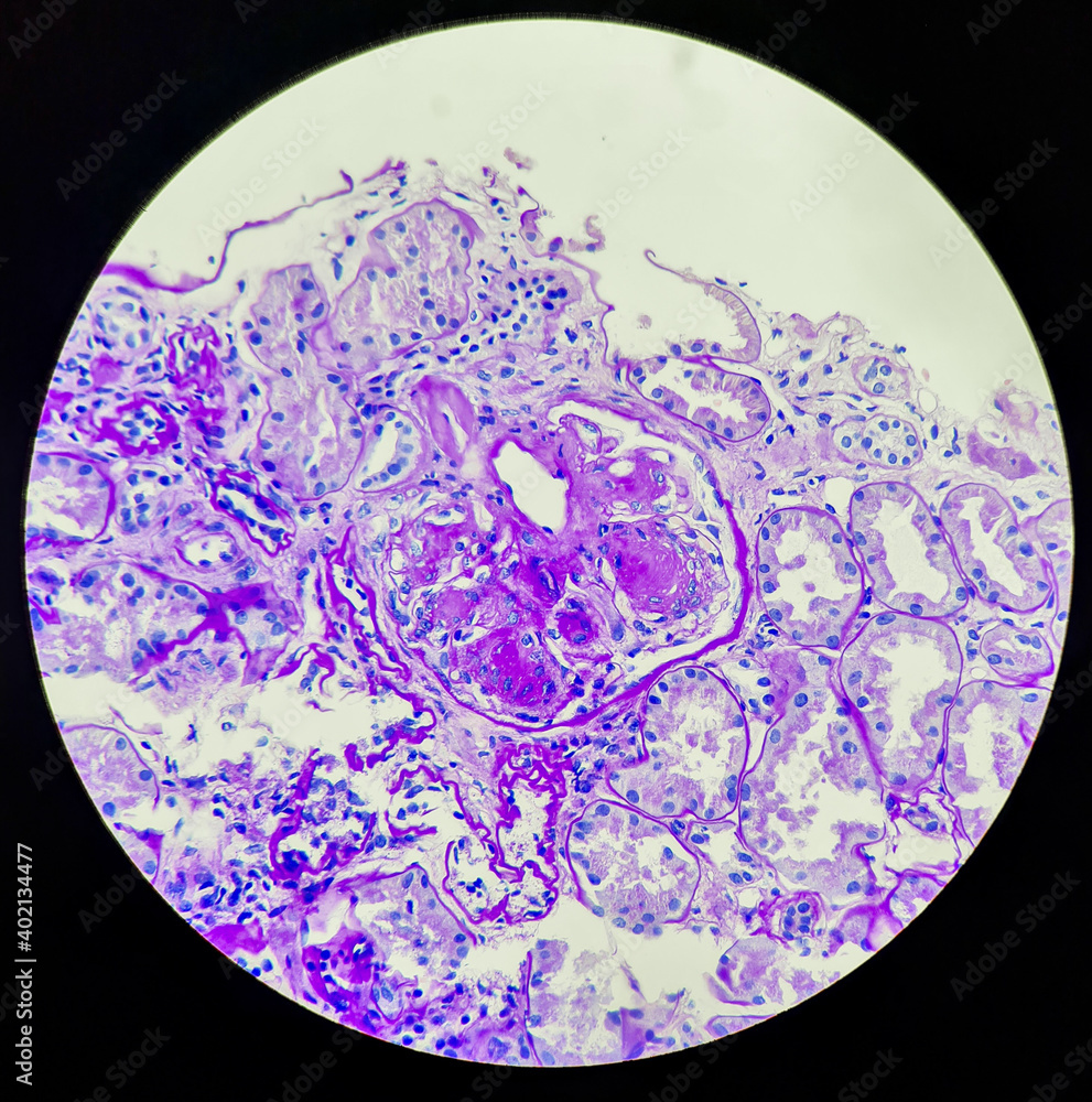 Photo of nodular glomerulosclerosis and hyalinosis in diabetic patient ...