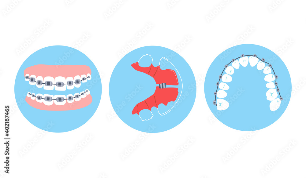 Dental braces, aligner or orthodontic metal retainers on teeth.Oral ...