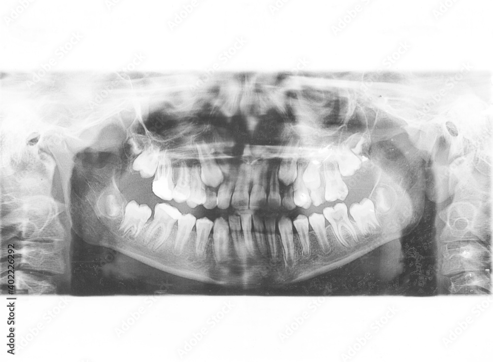 Orthopantomogram of a 12-year-old child. The upper canines and second ...