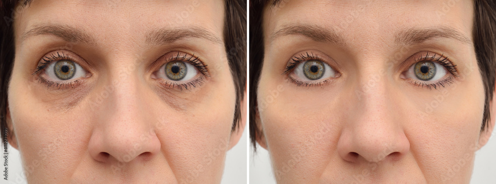 Female eye bags before and after cosmetic treatment or plastic ...