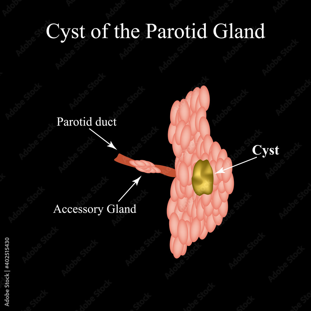 Parotid salivary gland cyst. The structure of the parotid salivary ...