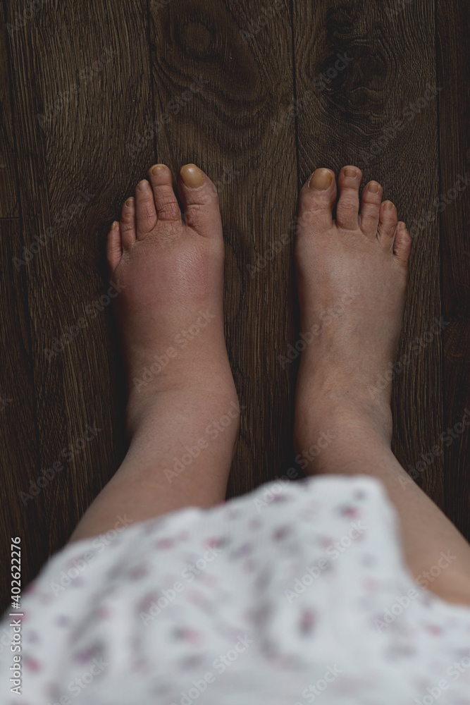 Swollen woman's feet with lymphedema condition Stock Photo | Adobe Stock
