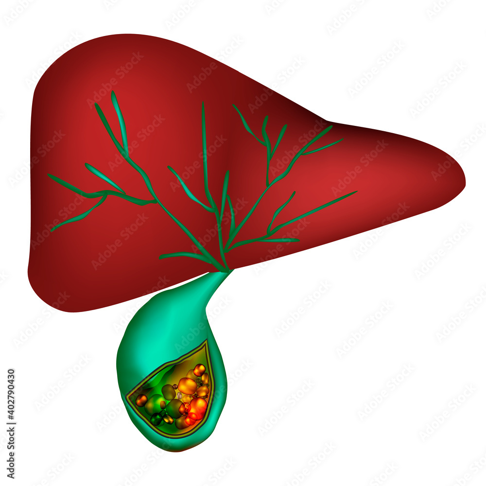 Gallstones. Cholelithiasis. Cholecystitis. Inflammation of the ...