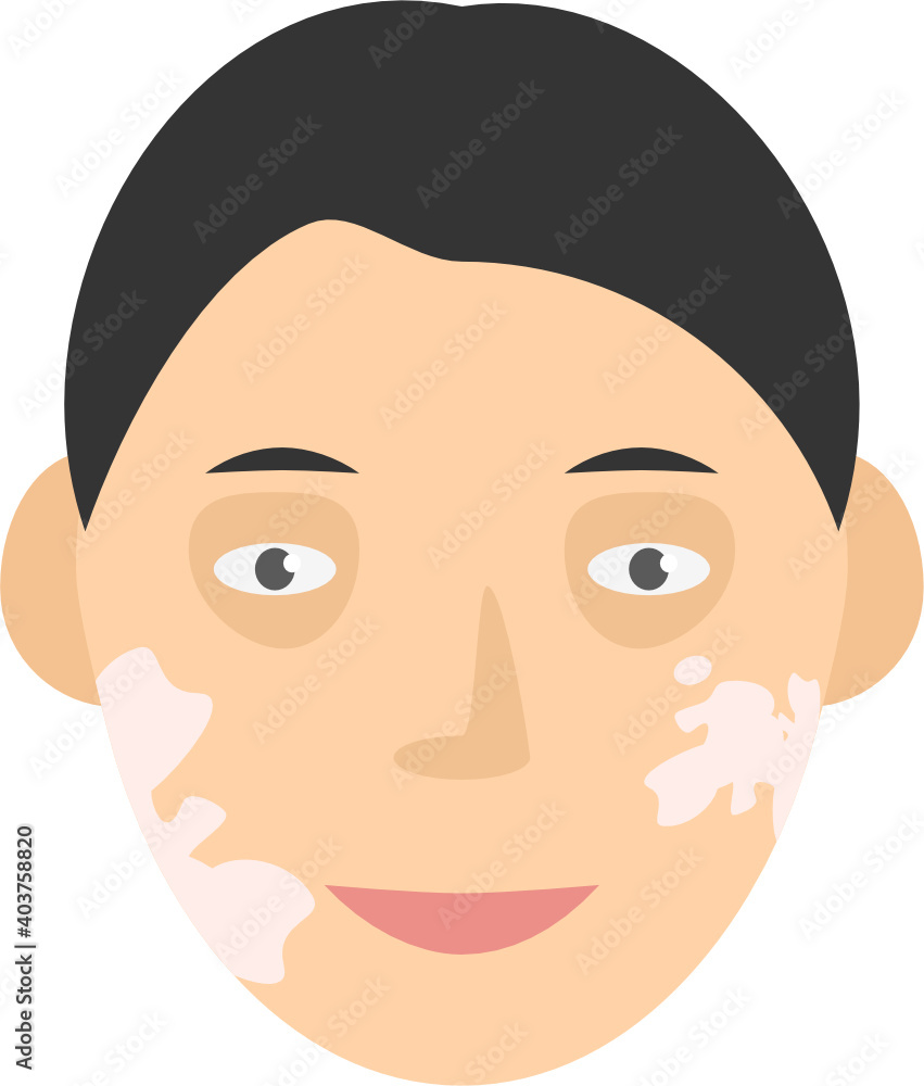 Human face with pigment birthmark short hair vector graphic clipart ...