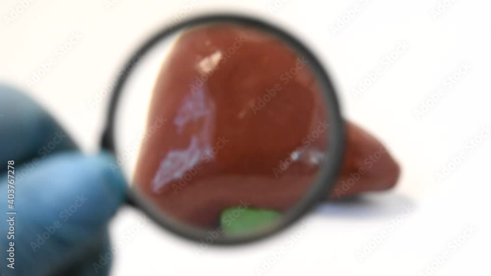 Diagnosis of human liver or hepatic system - body of gland, gallbladder ...