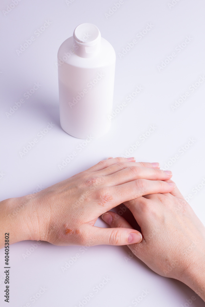 A remedy for eczema and dermatitis in women's hands. Dermatitis on the ...