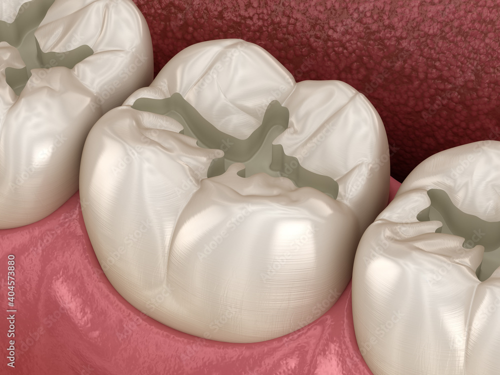 Prepareted Molar Fissure for fillings placement, Medically accurate 3D ...