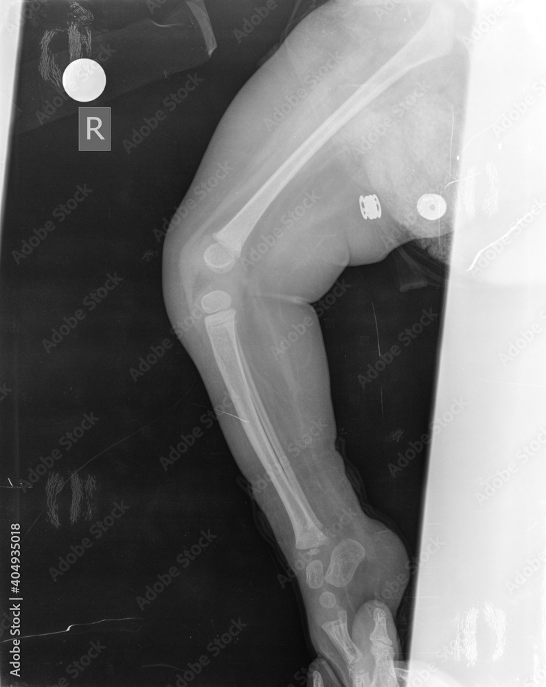 Broken x ray image of leg Stock Photo | Adobe Stock