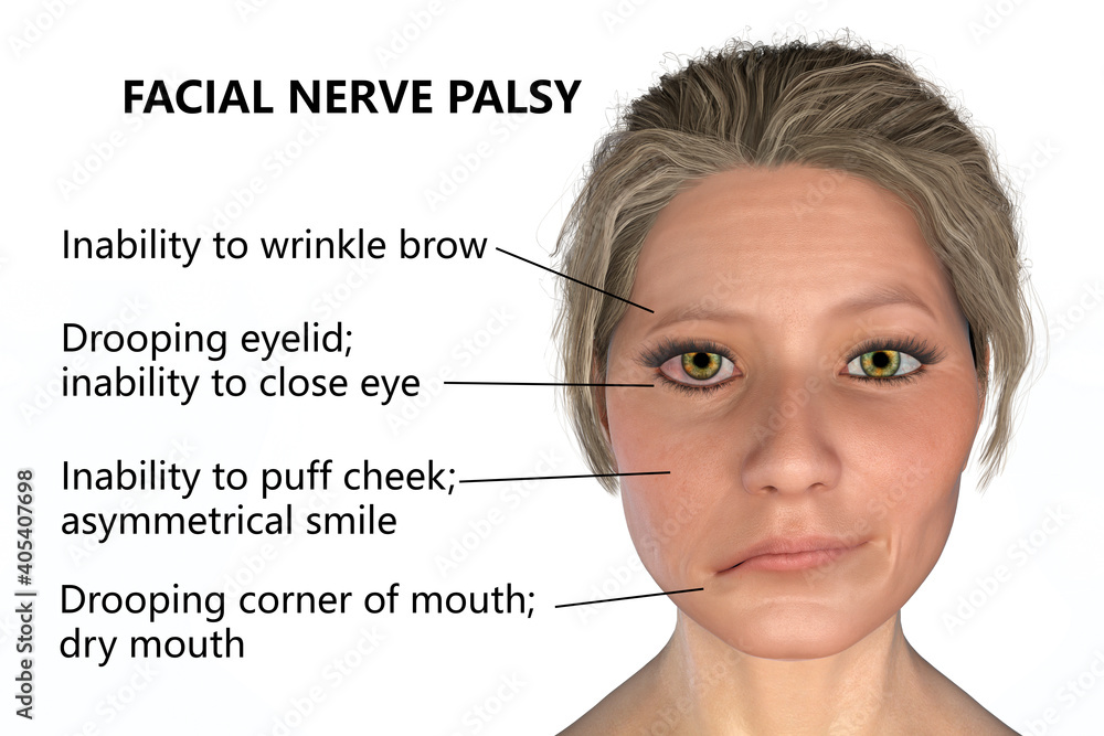 Póster Facial nerve paralysis, Bell's palsy – Cuadro para Pared ...