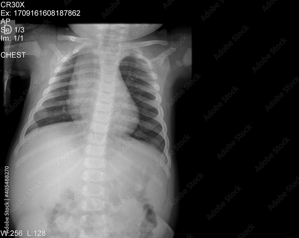 Chest x-ray image of the baby film.The scan show normal child condition ...