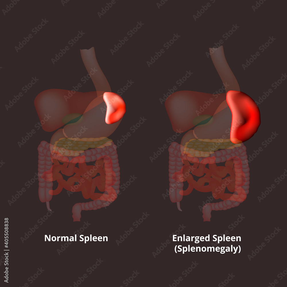 Splenomegaly of the spleen. Enlargement of the spleen. Vector ...