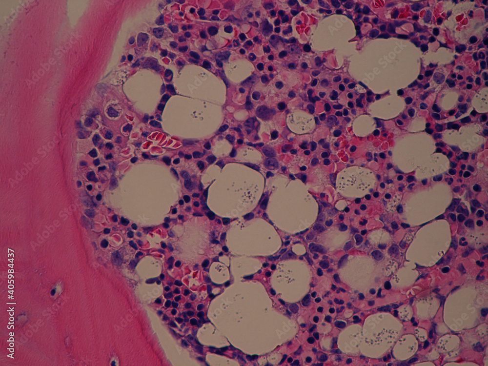 Bone Marrow Core Biopsy
