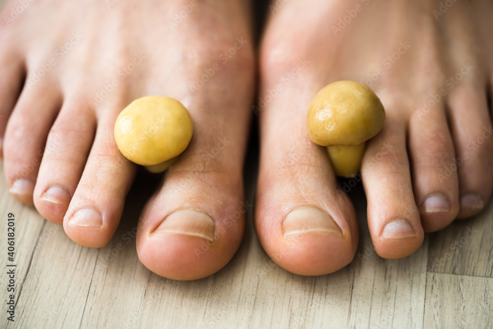 Fungus Mushroom Between Toenail. Smelly Feet Stock Photo | Adobe Stock