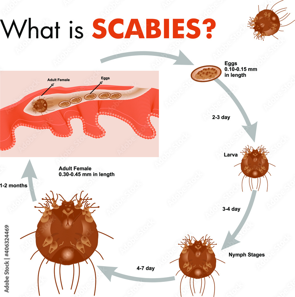 Scabies Disease poster creative design Stock Vector | Adobe Stock