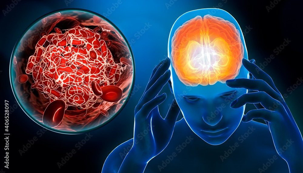 Man suffering of a cerebrovascular accident or stroke or brain attack ...