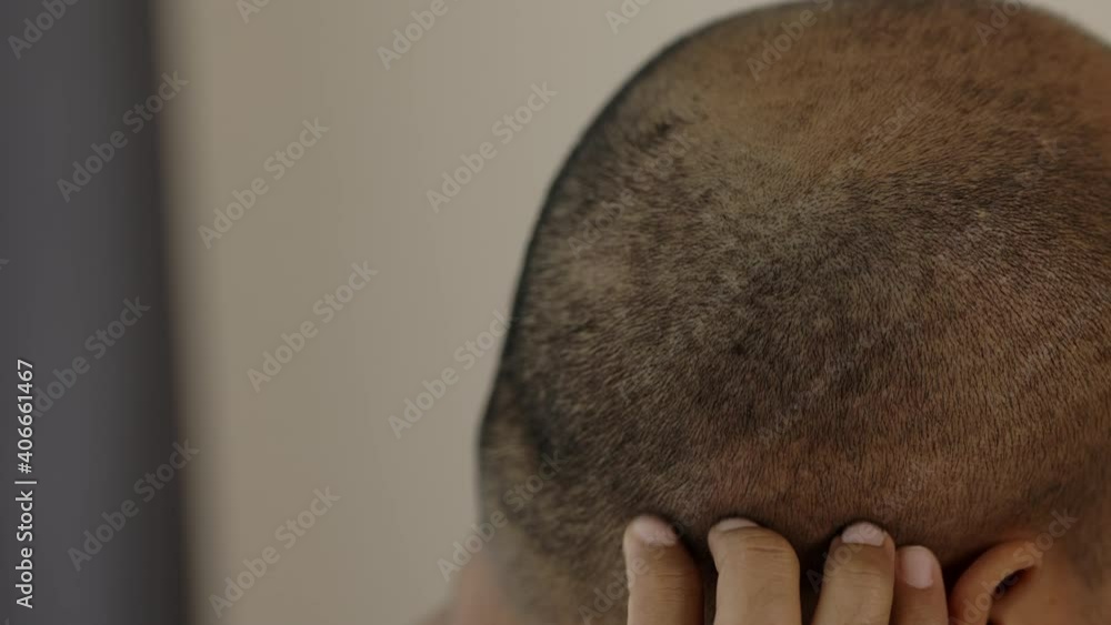 The young man has a skin disease. He has an itchy scalp. He scratched ...