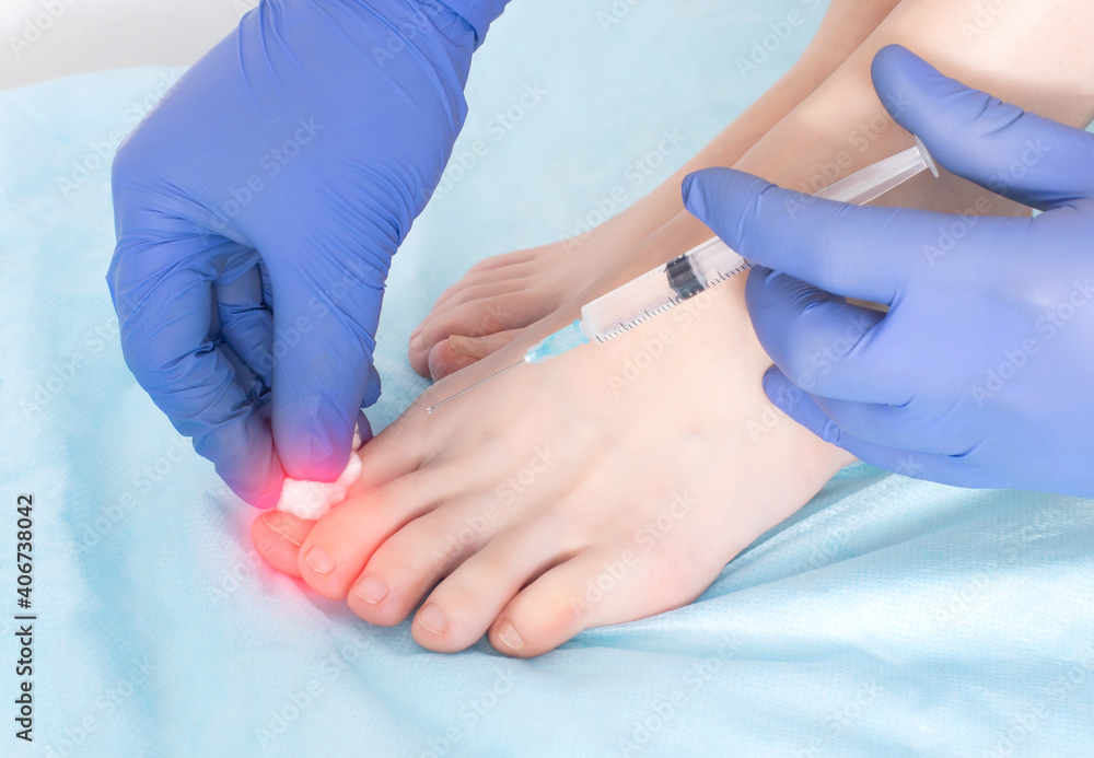 The doctor makes an injection in the joint of the toe for arthrosis ...