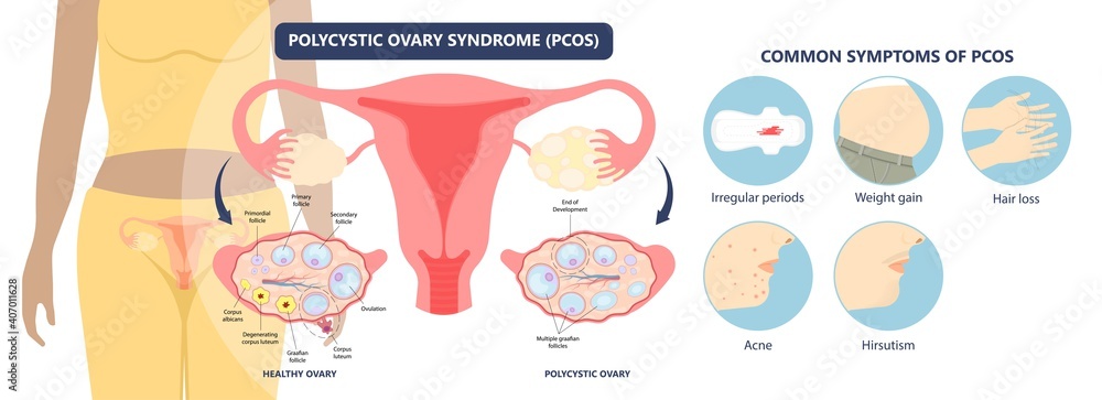 Cancer pelvic PCOS ovary Endo belly pain swelling uterus heavy ovaries ...