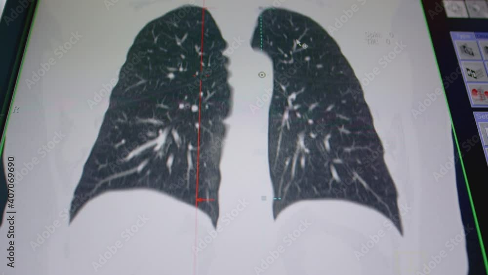 Stockvideon The result of a scan of the lungs on a computed tomograph. Lung model on a computer ...