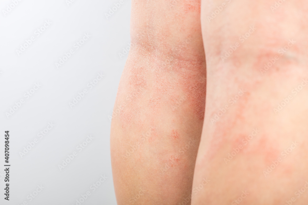 Acute atopic dermatitis on the legs behind the knees of a child is a ...