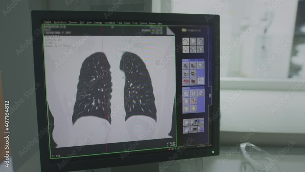 The result of a scan of the lungs on a computed tomograph. Lung model on a computer screen. CT ...