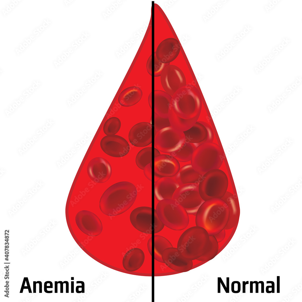 Vecteur Stock Anemia And Normal Ammount Of Red Blood Cells In A Drop Of vecteur-stock-anemia-and-normal-ammount-of-red-blood-cells-in-a-drop-of