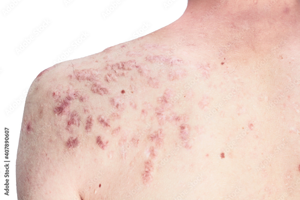 Skin Conditions On Back