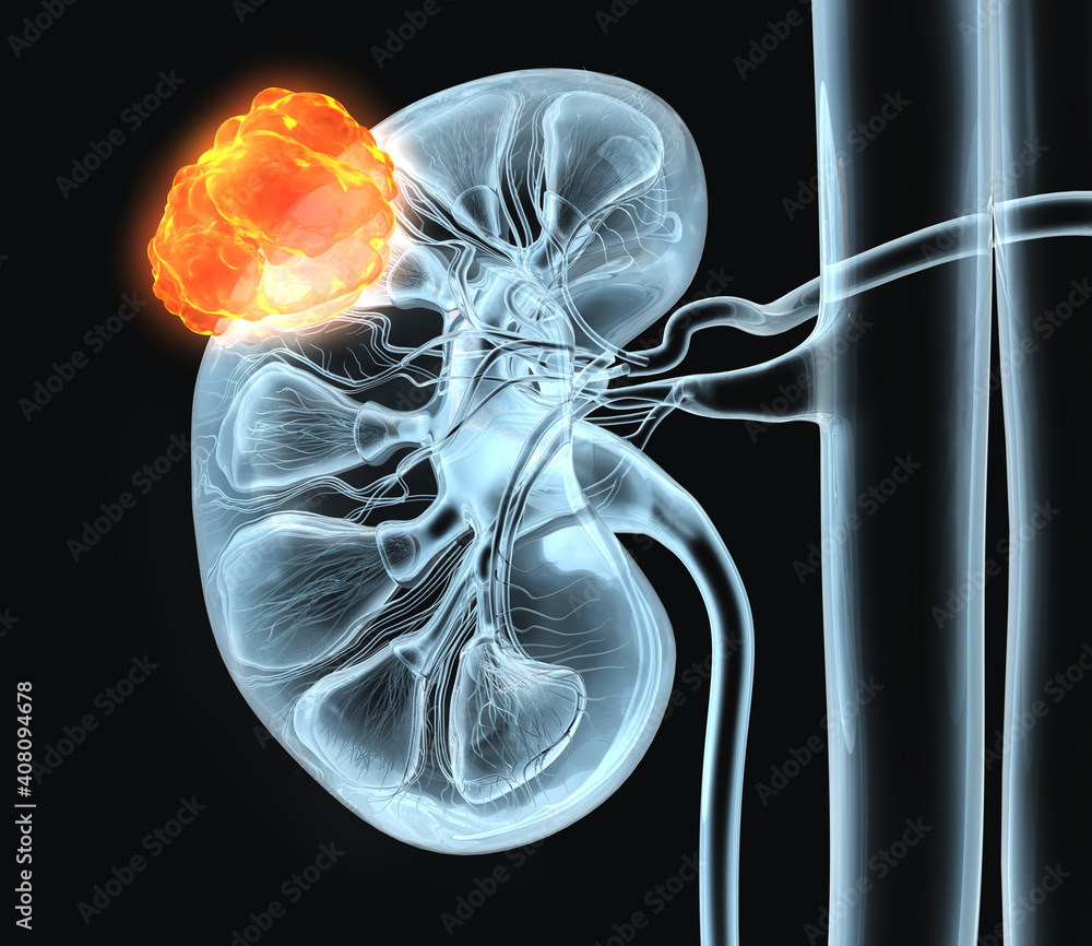 Kidney cancer, human kidney cross section, x-ray style, medical 3D ...