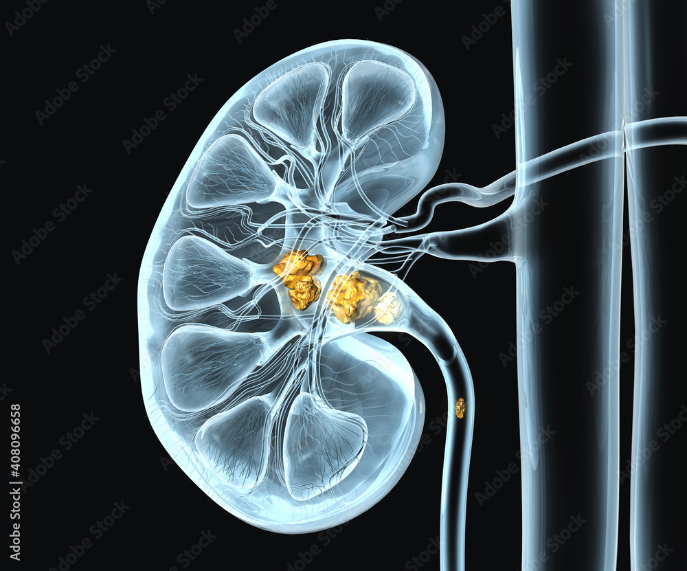 Póster Kidney stones in minor and major calyces and ureter, medically ...