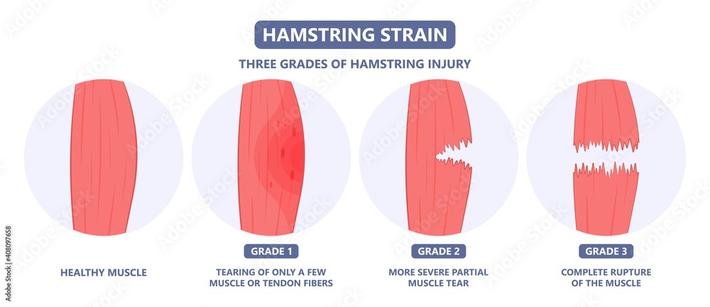 Muscle Strain Grades