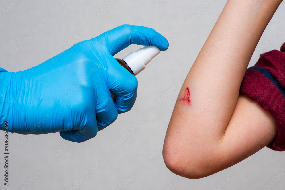 Doctors hand sprays an antiseptic agent on the wound on the childs hand ...