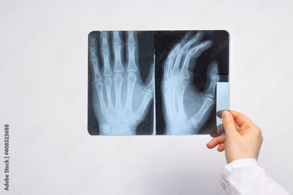A doctor or radiologist holds an X-ray of a patient with a hand injury ...