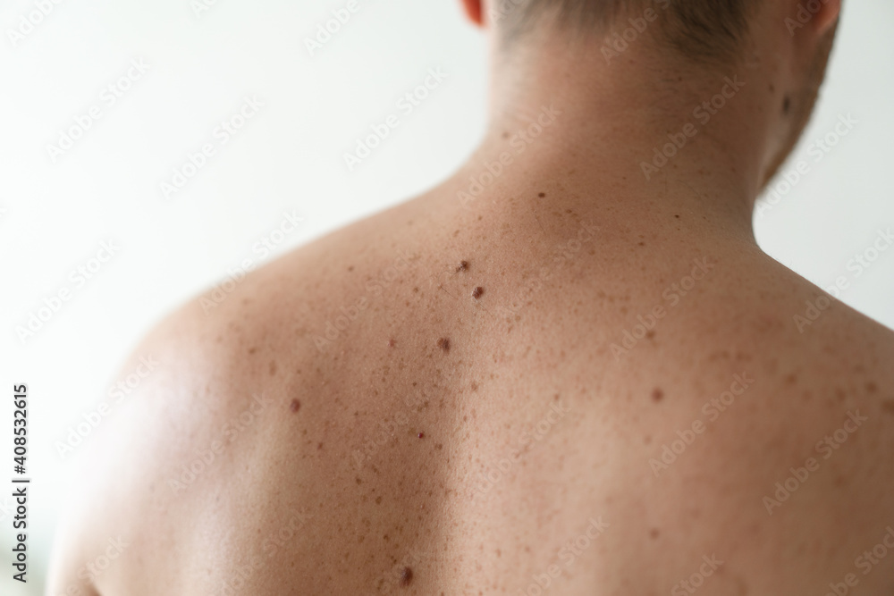 Checking benign moles. Close up detail of the bare skin on a man back ...