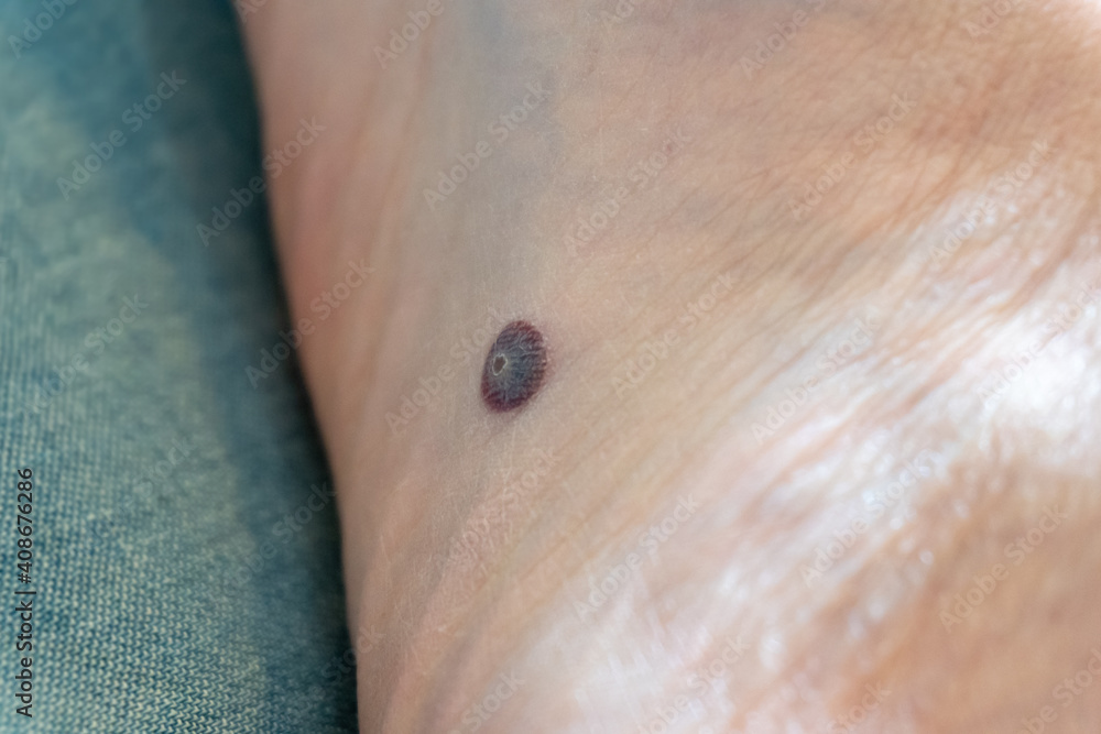Human papillomavirus infection (HPV) of a plantar wart, treated with ...