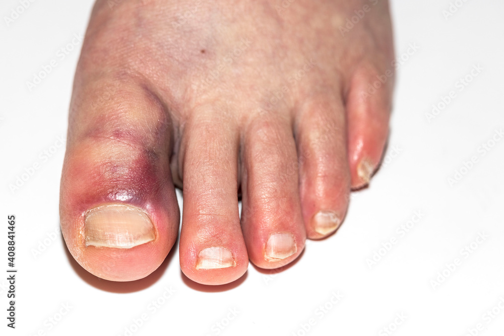Brusing On Foot Store | emergencydentistry.com