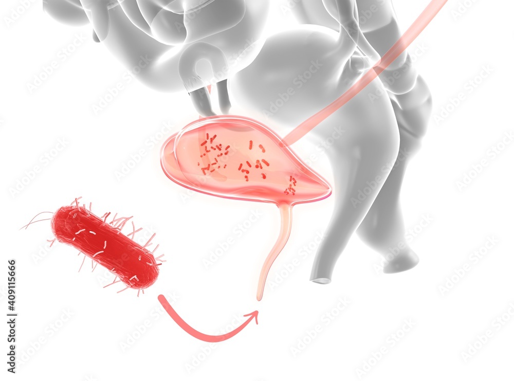 Cystitis, urinary tract infection or inflammation of the bladder caused ...